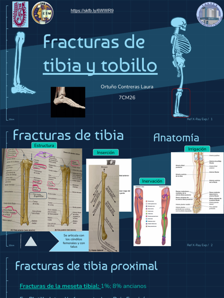 Fracturas de Tibia y Tobillo | PDF | Rodilla | Tobillo