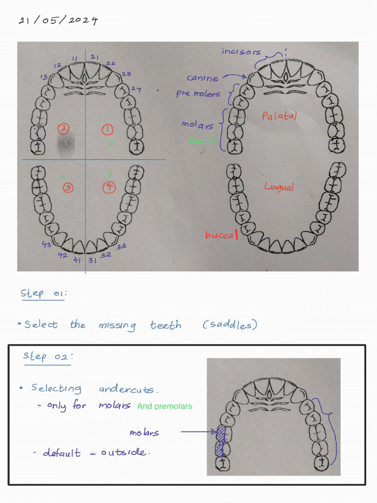 Denture Design Basics 240521 122732 | PDF