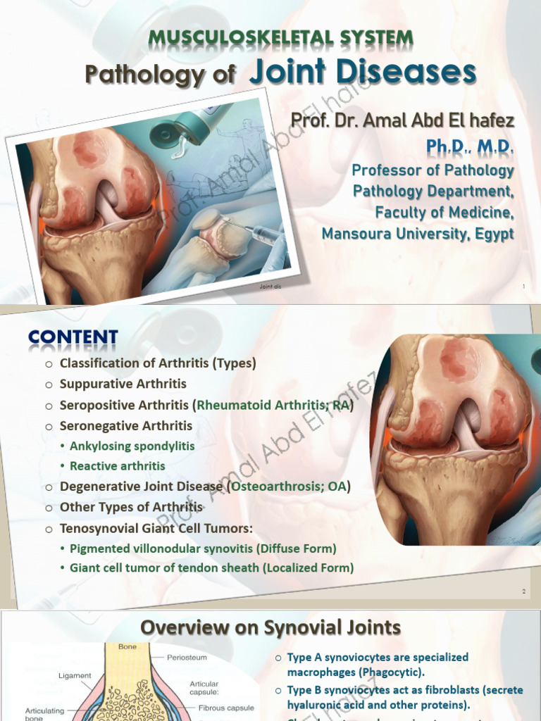 Diseases of Joints Prof. Amal Abd El Hafez | PDF | Rheumatoid Arthritis | Osteoarthritis