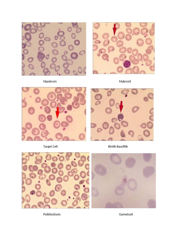Gambar Eritrosit Abnormal | PDF