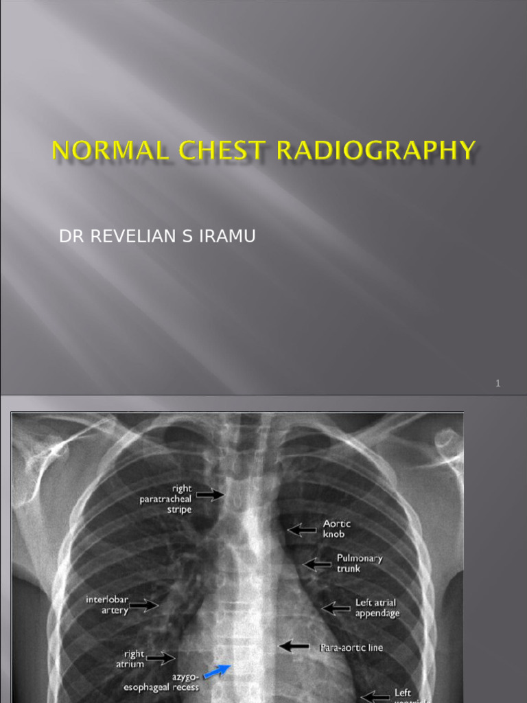 Normal Chest X-Ray 1-11 | PDF | Thorax (Human Anatomy) | Medical ...