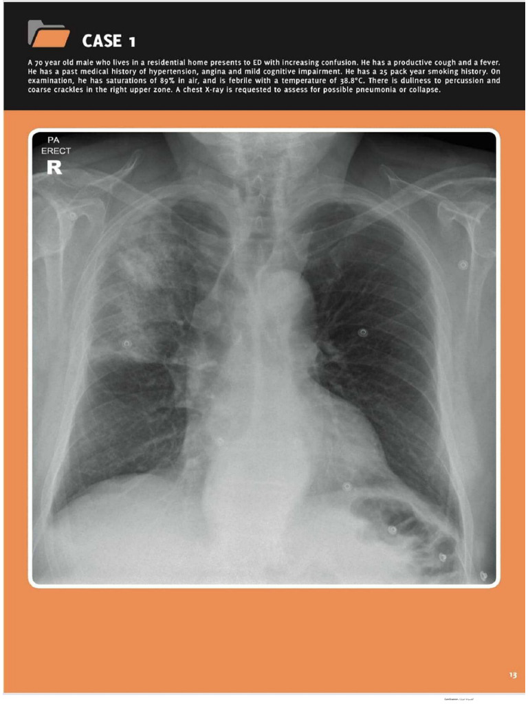 Radx Chest Cases | PDF