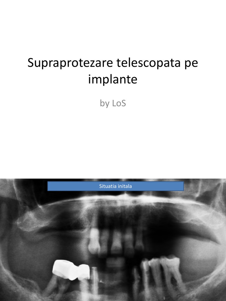 Supraprotezare Telescopata Pe Implante | PDF