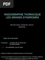 Sémiologie radiologique du syndrome bronchique | PDF | Poumon ...