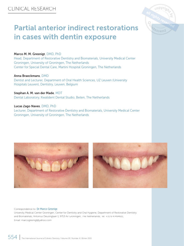 Partial Anterior Indirect Restorations in Cases With Dentin Exposure ...