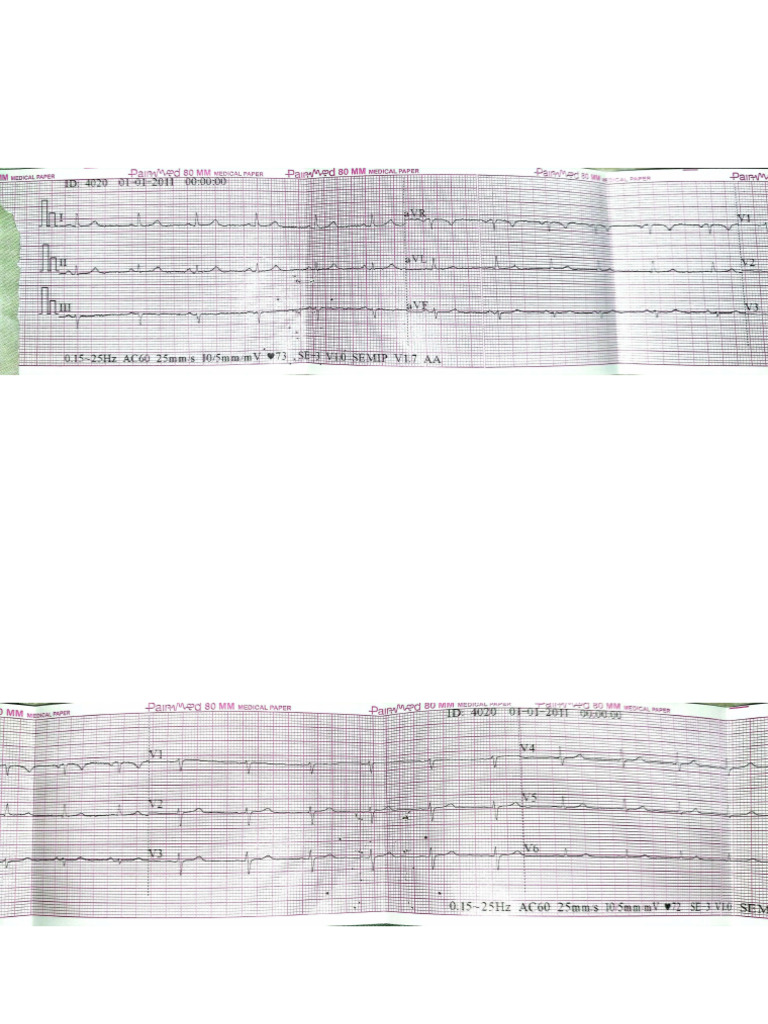 Electro Cardiogram | PDF