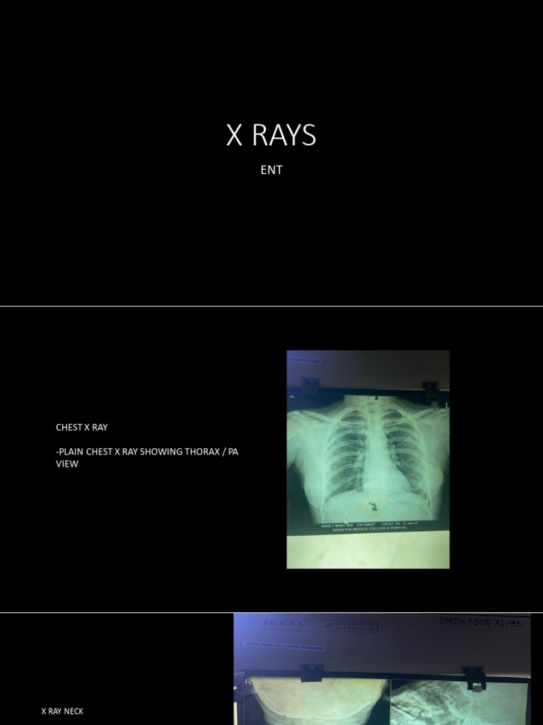X Rays Ent | PDF