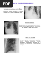 Signos Radiológicos Neumoperitoneo | PDF