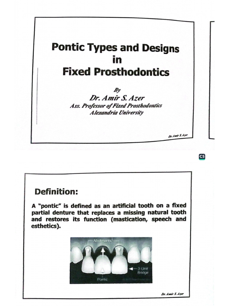 2 - Pontic Types & Designs | PDF