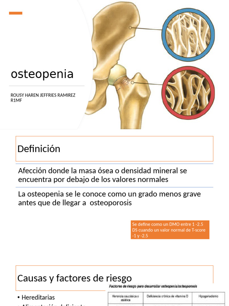 Osteopenia: Causas, Diagnóstico y Tratamiento | PDF | Vitamina D ...