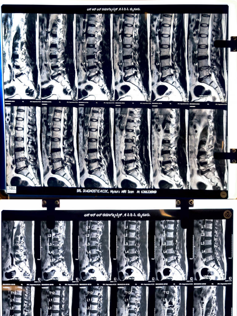 MRI Lumbar Spine Report | PDF | Vertebra | Skeletal System