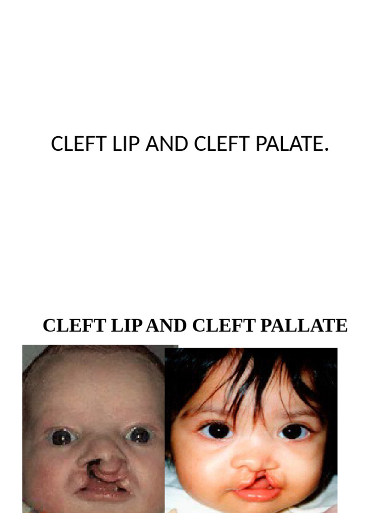 Understanding Cleft Lip and Palate | PDF | Health Sciences | Medical ...