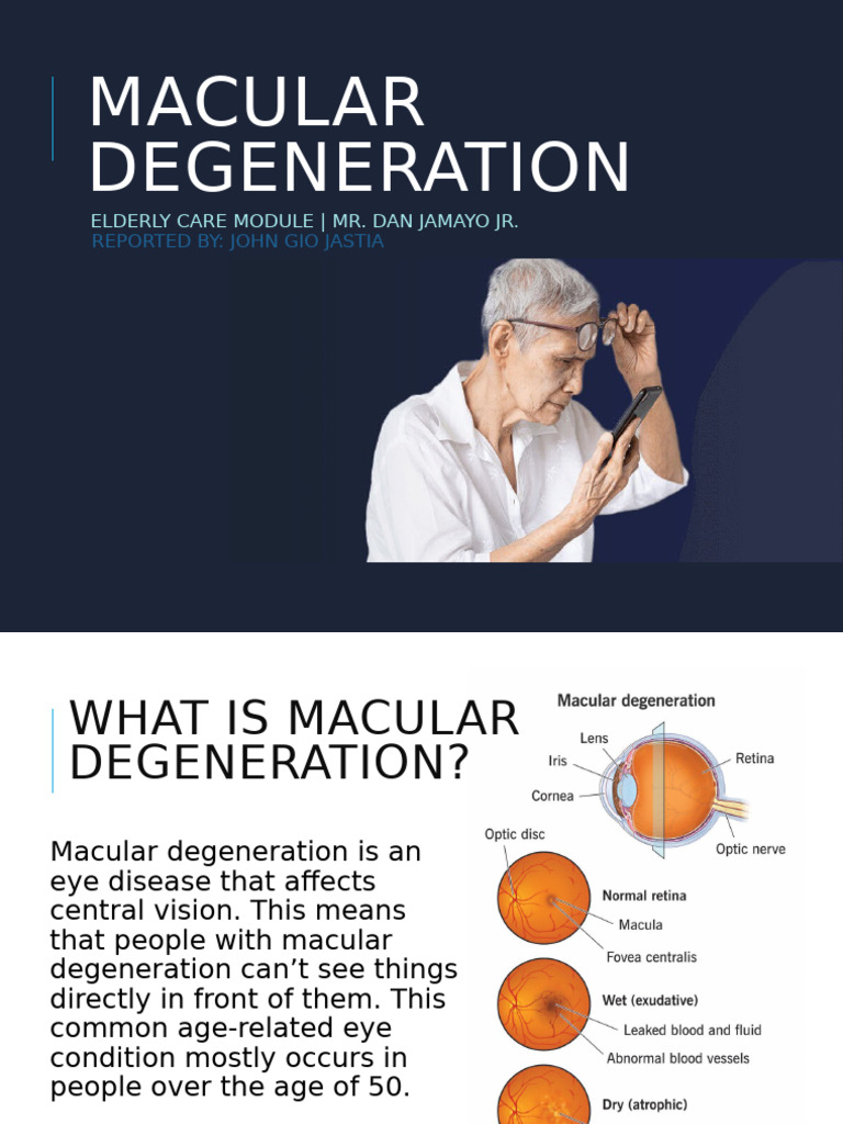 Macular Degeneration | PDF | Visual Impairment | Medical Specialties
