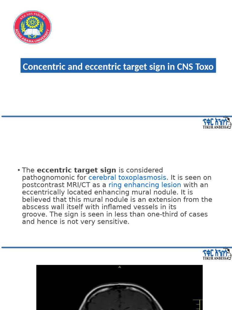 Concentric and Eccentric Target Sign | PDF | Magnetic Resonance Imaging ...