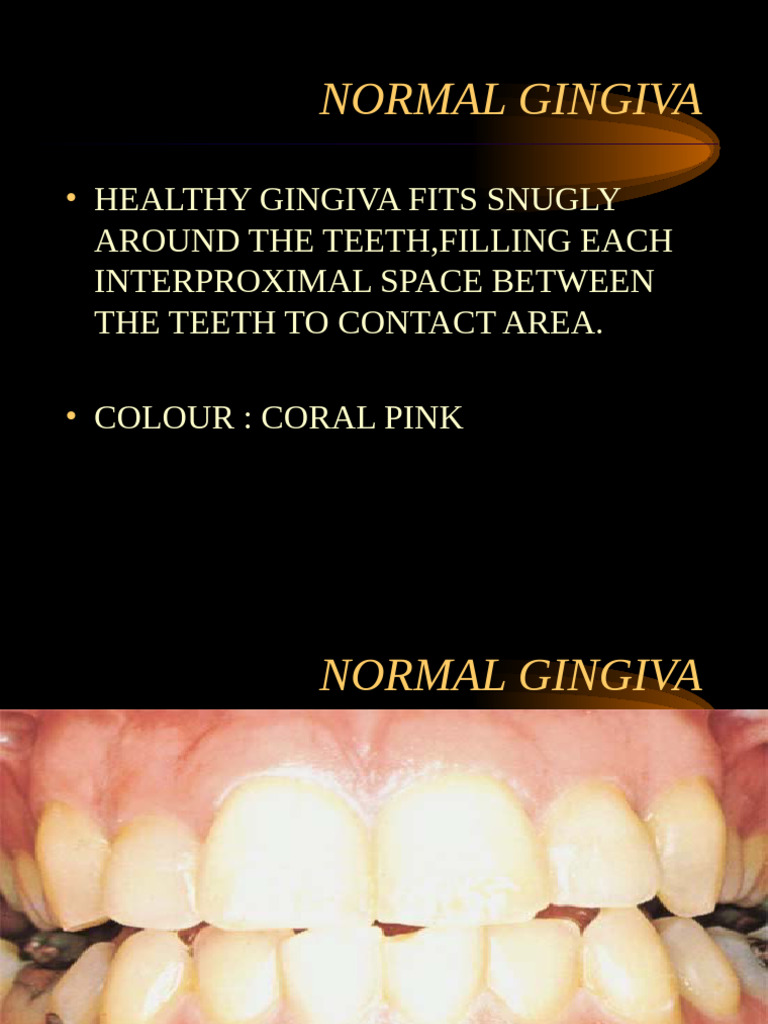 Marginal Periodontitis Overview | PDF | Periodontology | Mouth