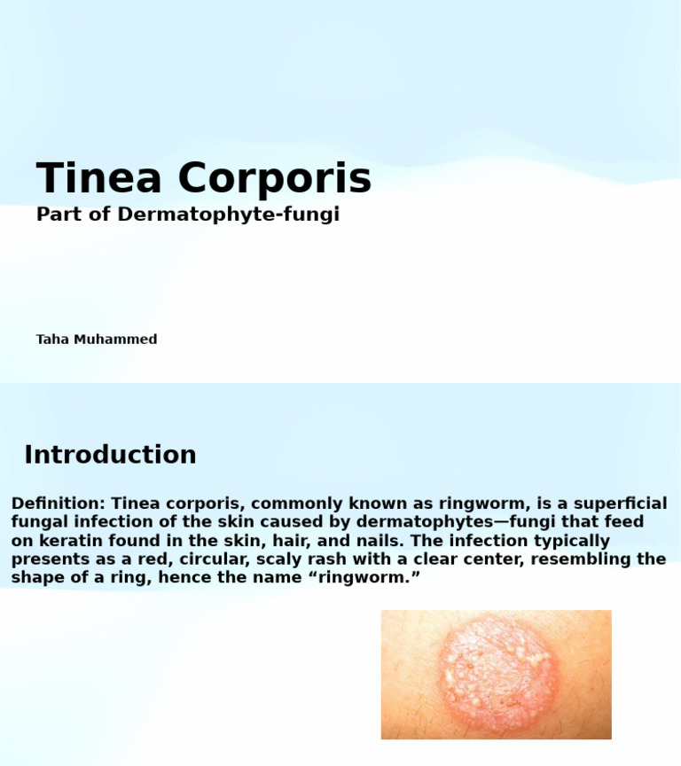 Tinea Corporis: Ringworm Overview | PDF