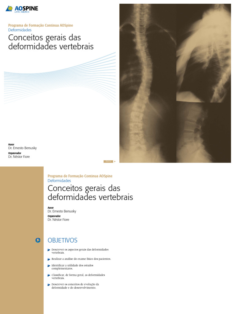 1 - Conceitos Gerais Das Deformidades Vertebrais | PDF | Escoliose ...