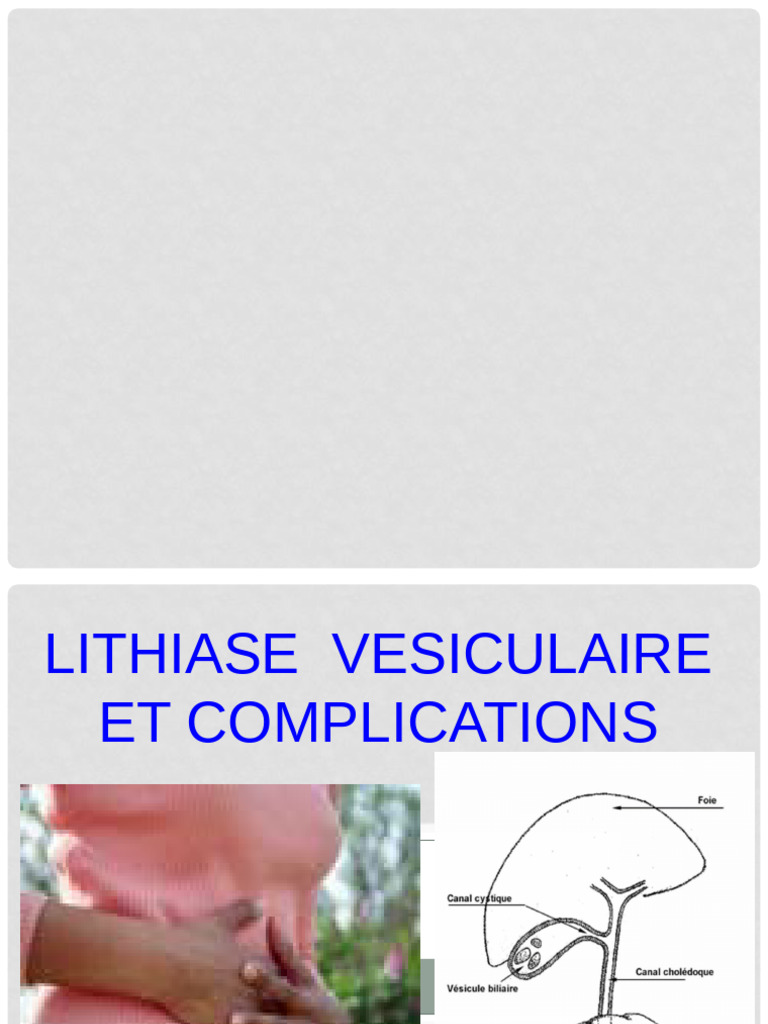 Lithiase vésiculaire et complications | PDF | Vésicule biliaire ...