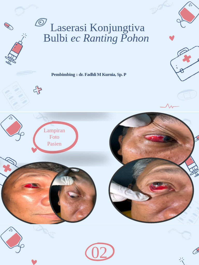Laserasi Konjungtiva | PDF