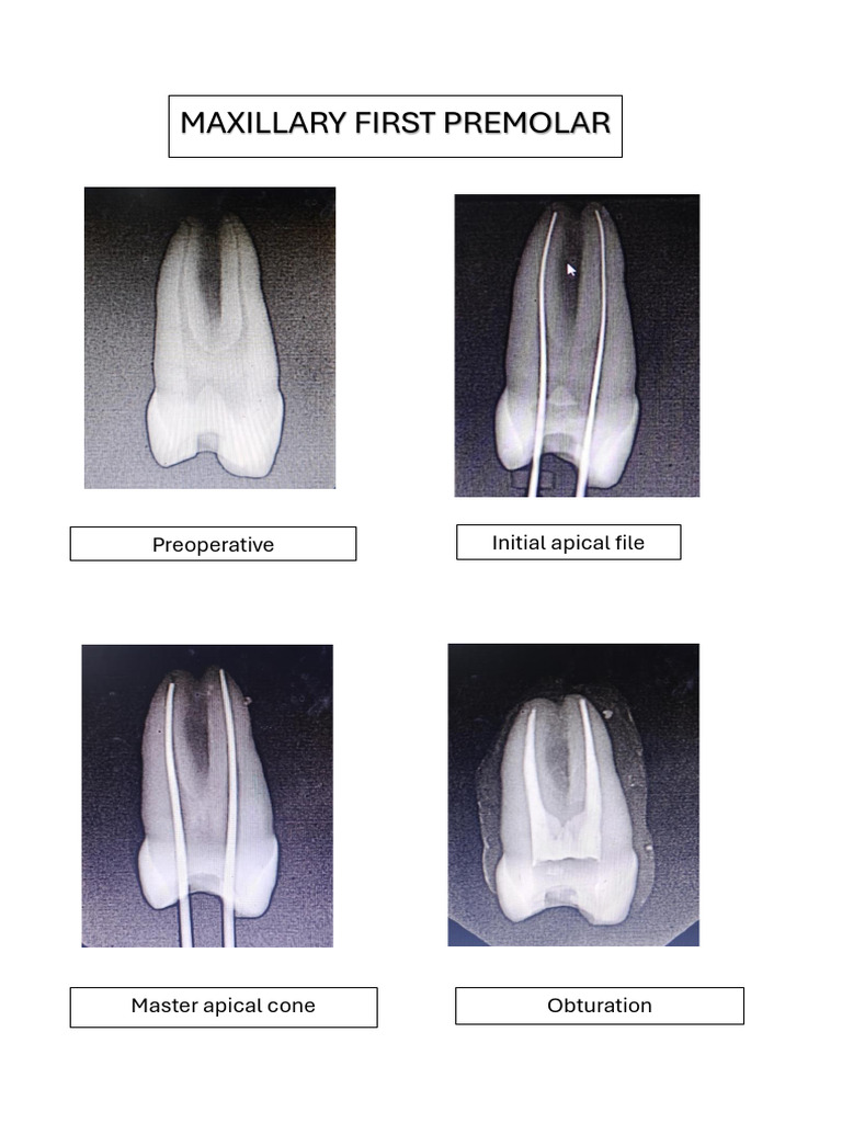 Premolar Rct | PDF