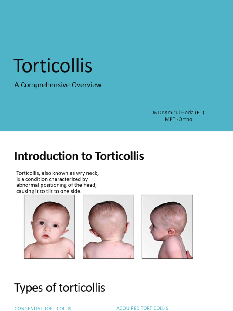Torticollis | PDF | Clinical Medicine | Diseases And Disorders
