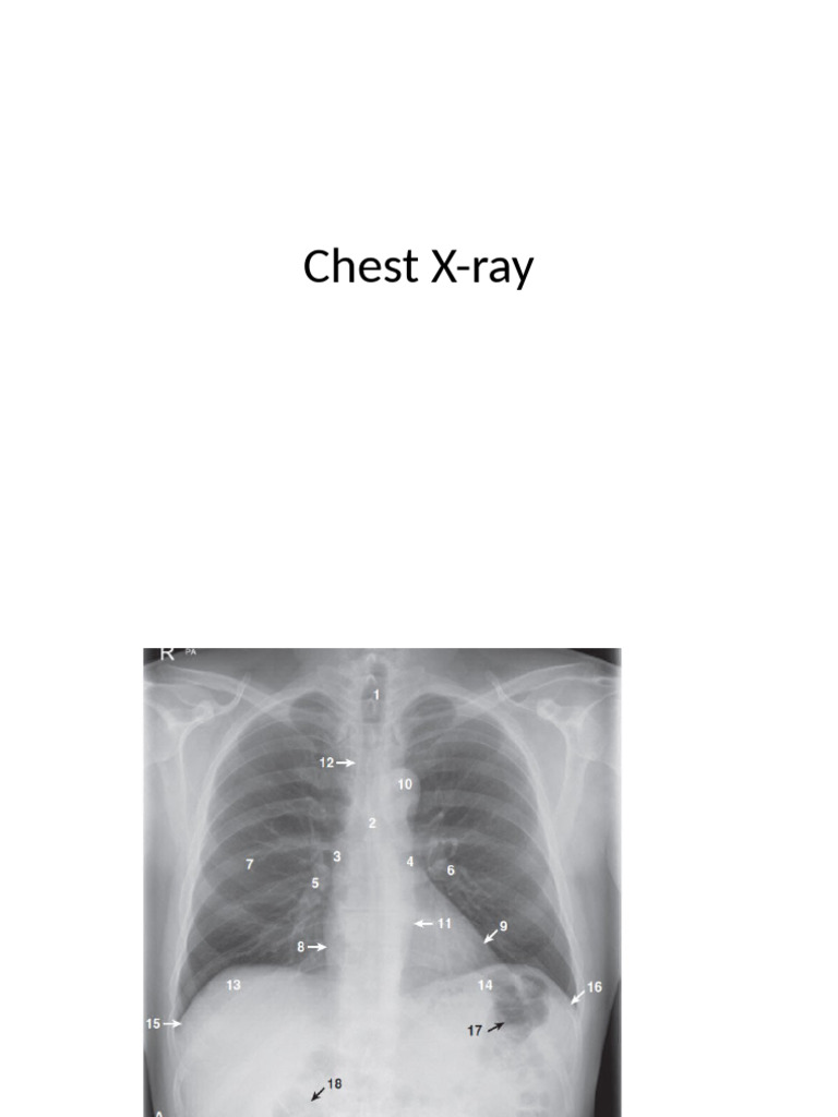 Chest X-Ray | PDF