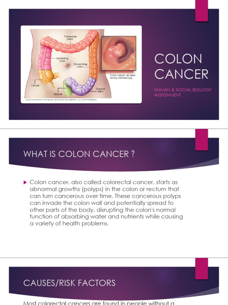 Colon Cancer | PDF
