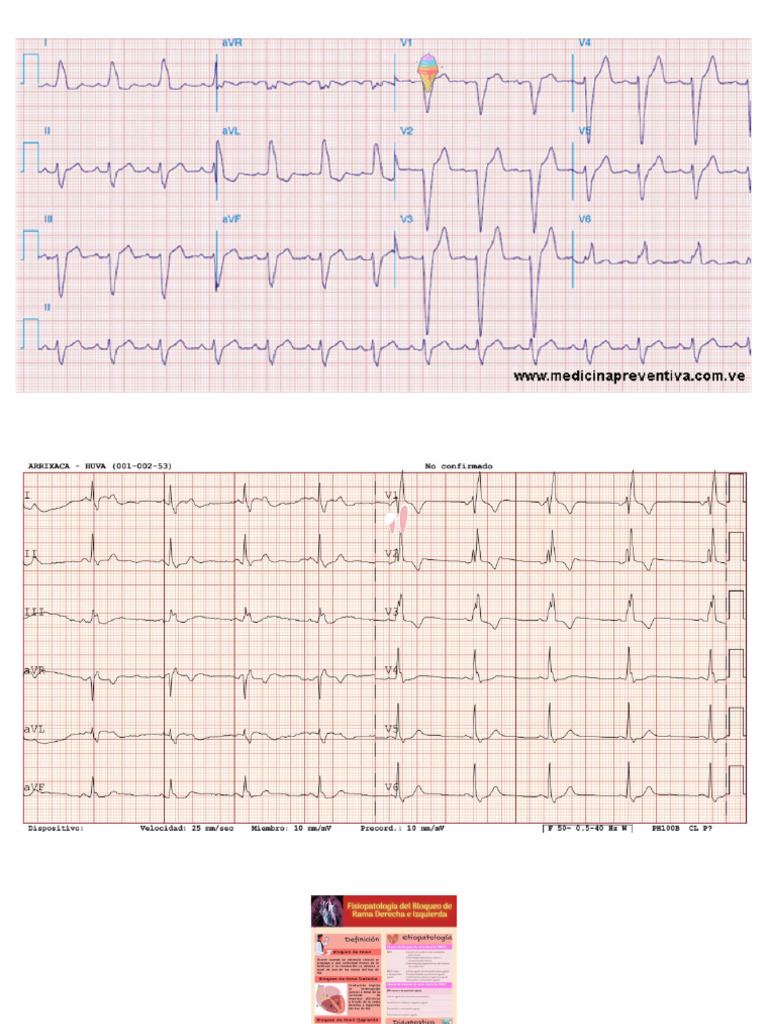 Bloqueos Cardio | PDF