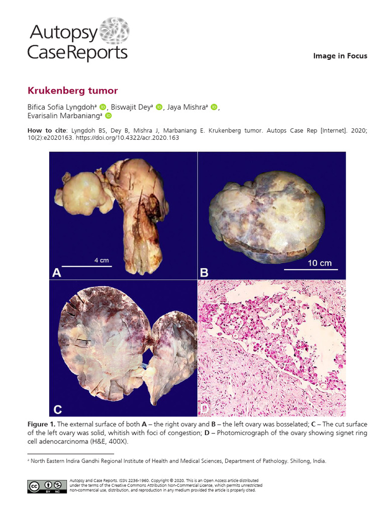 Autopsy 10 2 E2020163 | PDF | Ovarian Cancer | Metastasis