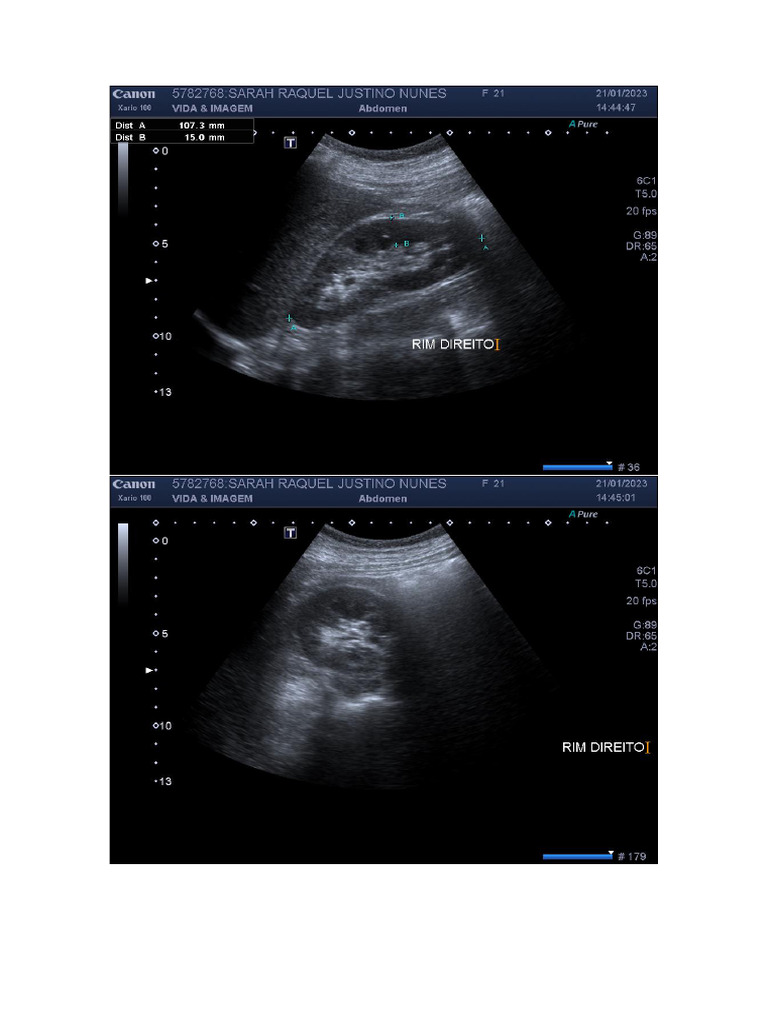 Usg - Rins e Vias Urinárias | PDF