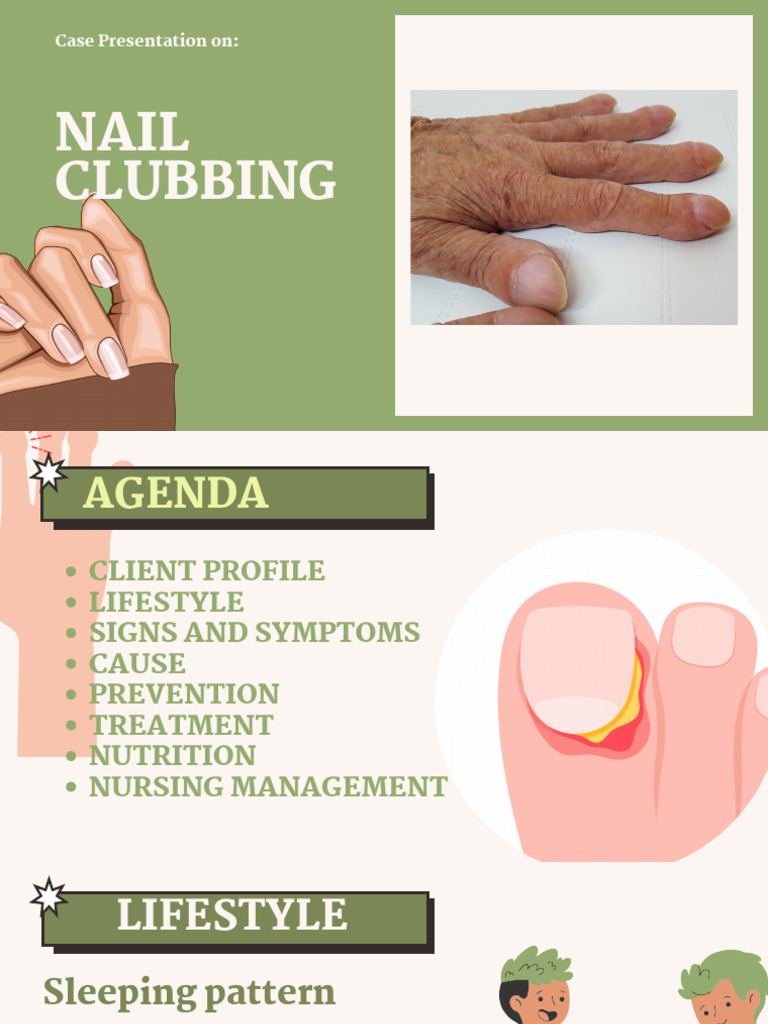 Nail Clubbing: Causes, Symptoms, and Management | PDF | Nail (Anatomy ...