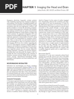 Understanding Midline Shift on CT | PDF | Ct Scan | Cerebrospinal Fluid