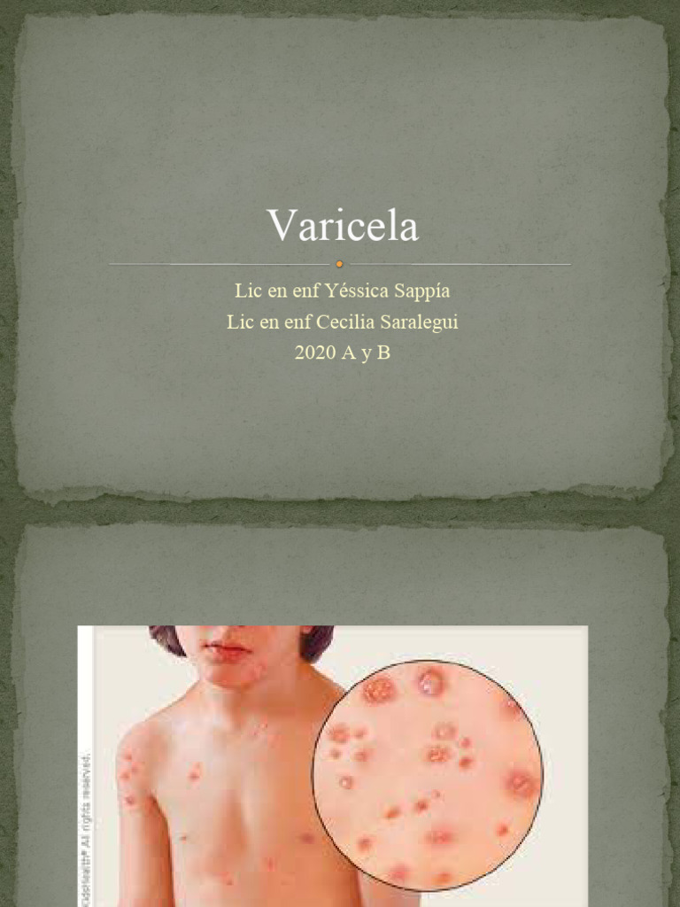 Varicela | PDF | Medicina | Ciencias de la Salud