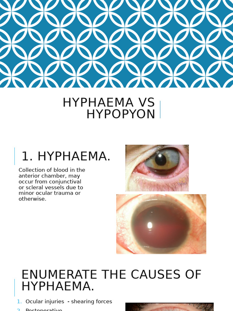 Hyphema vs. Hypopyon: Key Differences | PDF | Corticosteroid | Causes ...