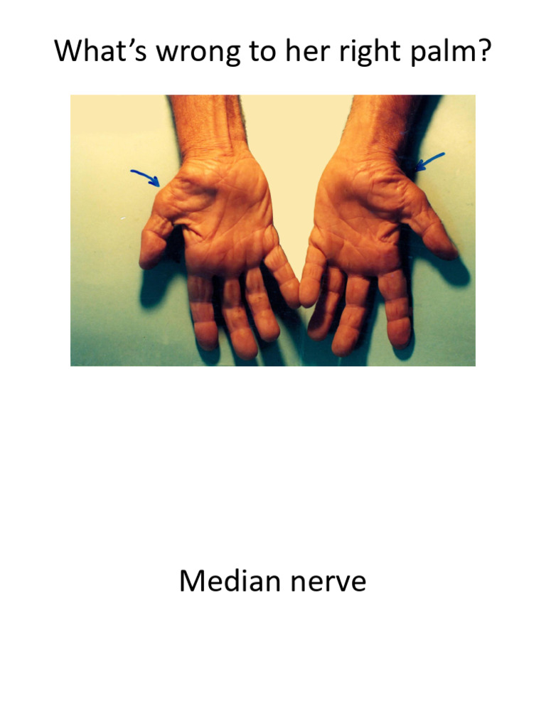 Median nerve | PDF | Hand | Nervous System