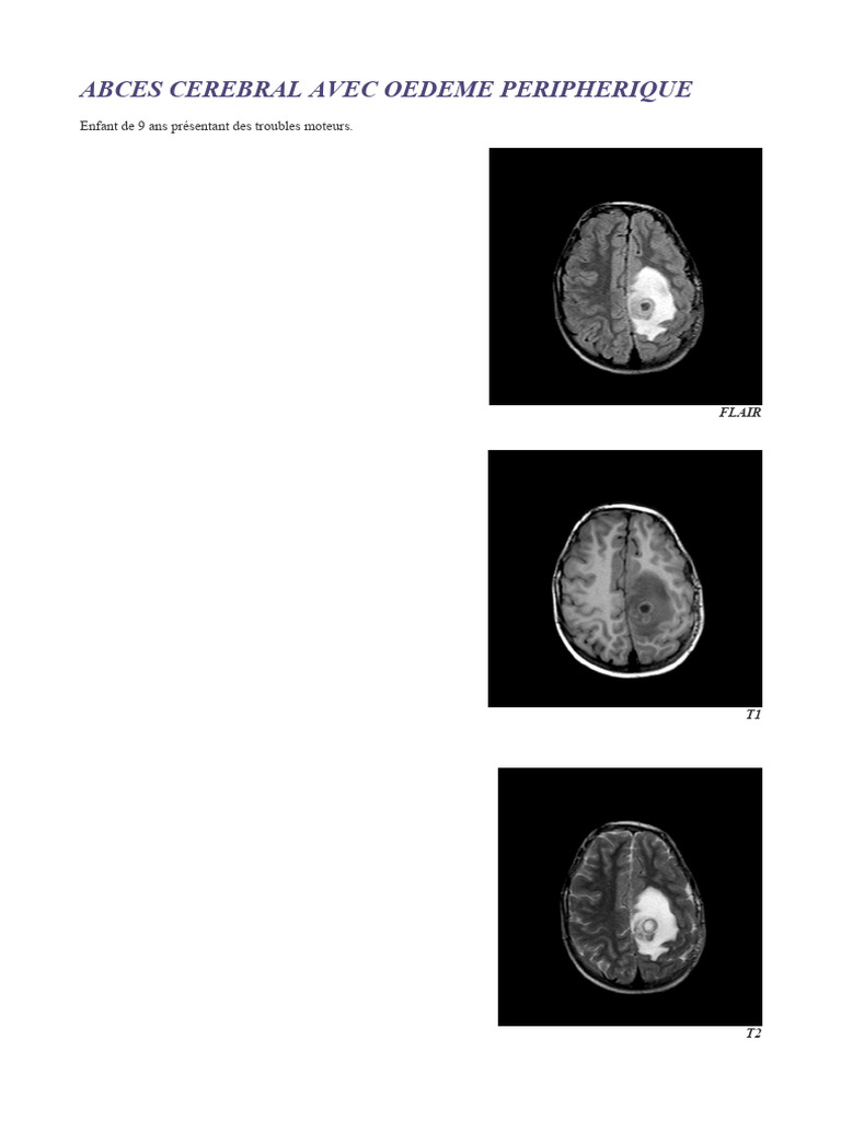 ABCES CEREBRAL AVEC OEDEME PERIPHERIQUE | PDF