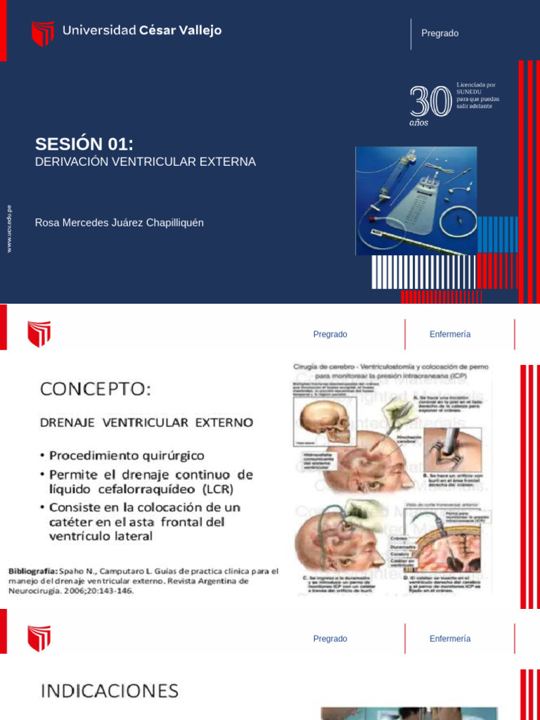 Derivación Ventricular Externa | PDF