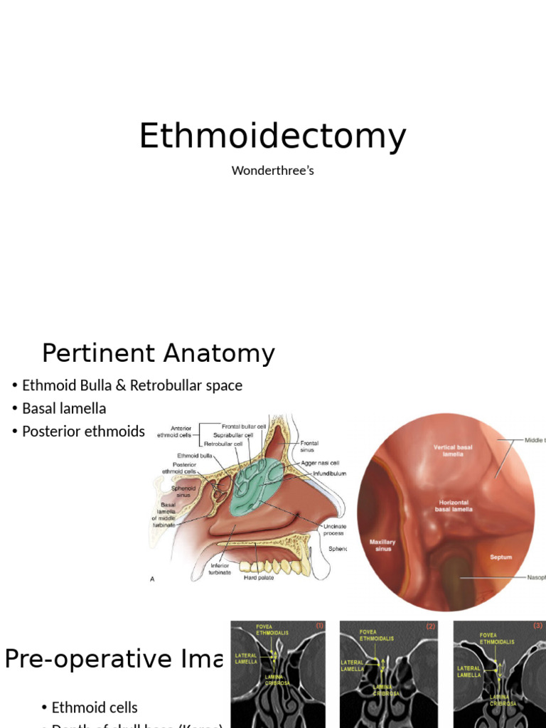Ethmoidectomy | PDF