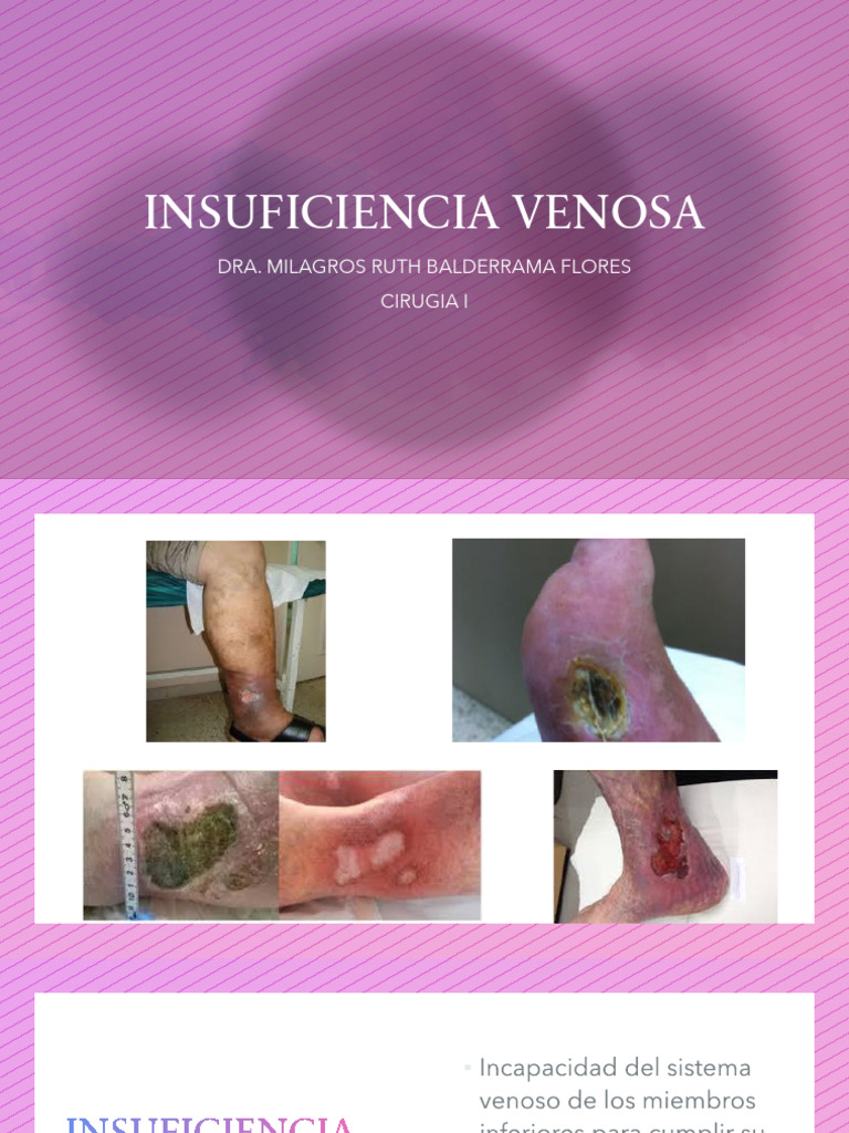 Insuficiencia Venosa Crónica y Úlceras | PDF | Venas varicosas | Diabetes