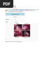 Laparoscopic Cholecystectomy With IOC | PDF | Gallbladder | Liver