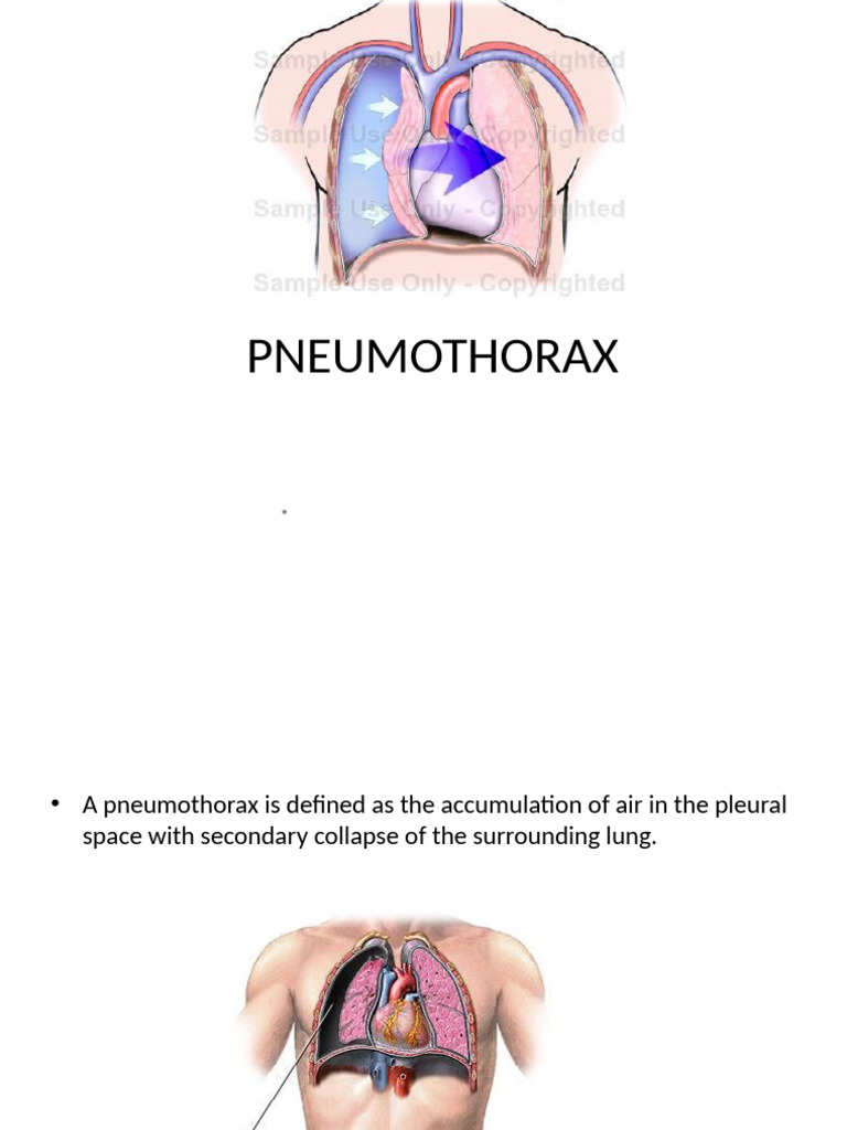 Understanding Pneumothorax: Types and Causes | PDF | Lung | Pulmonology