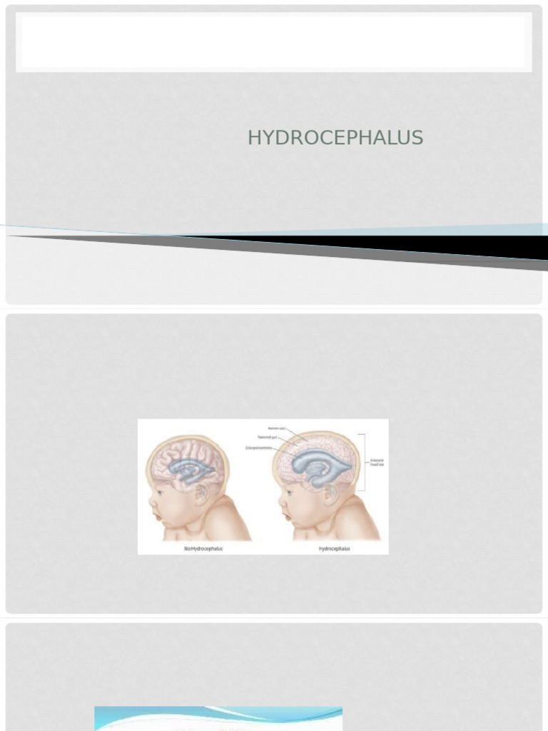 HYDROCEPHALUS | PDF | Cerebrospinal Fluid | Clinical Medicine