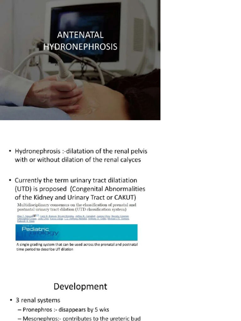 Antenatal Hydronephrosis | PDF