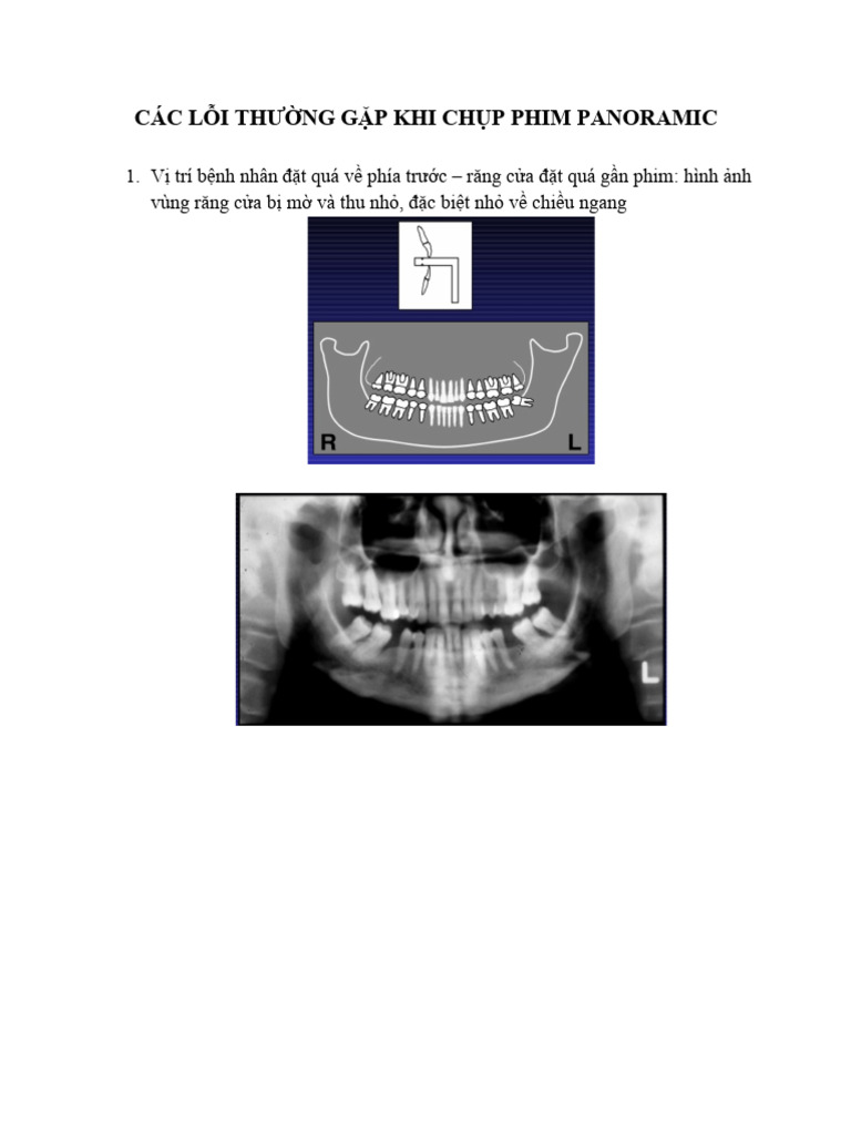 CÁC LỖI THƯỜNG GẶP KHI CHỤP PHIM PANORAMIC | PDF