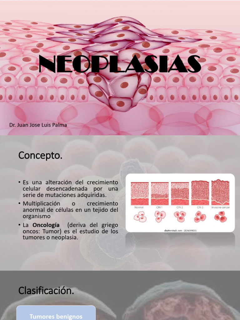 Semana 6 Neoplasias (1) | PDF | Neoplasias | Cáncer