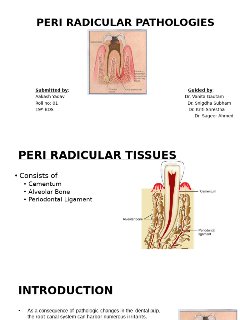 Aakash Yadv Peri Radicular Pathologies | PDF | Human Tooth | Dentistry ...