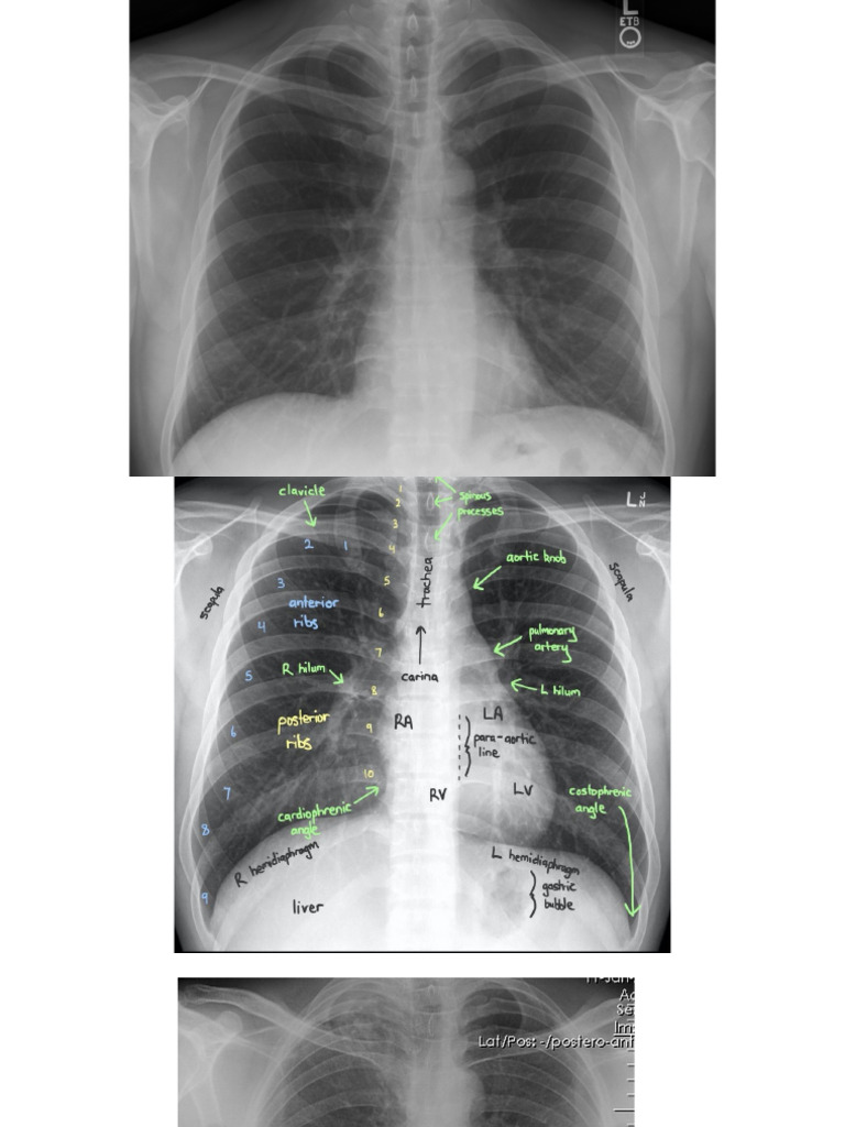 Chest x-ray | PDF