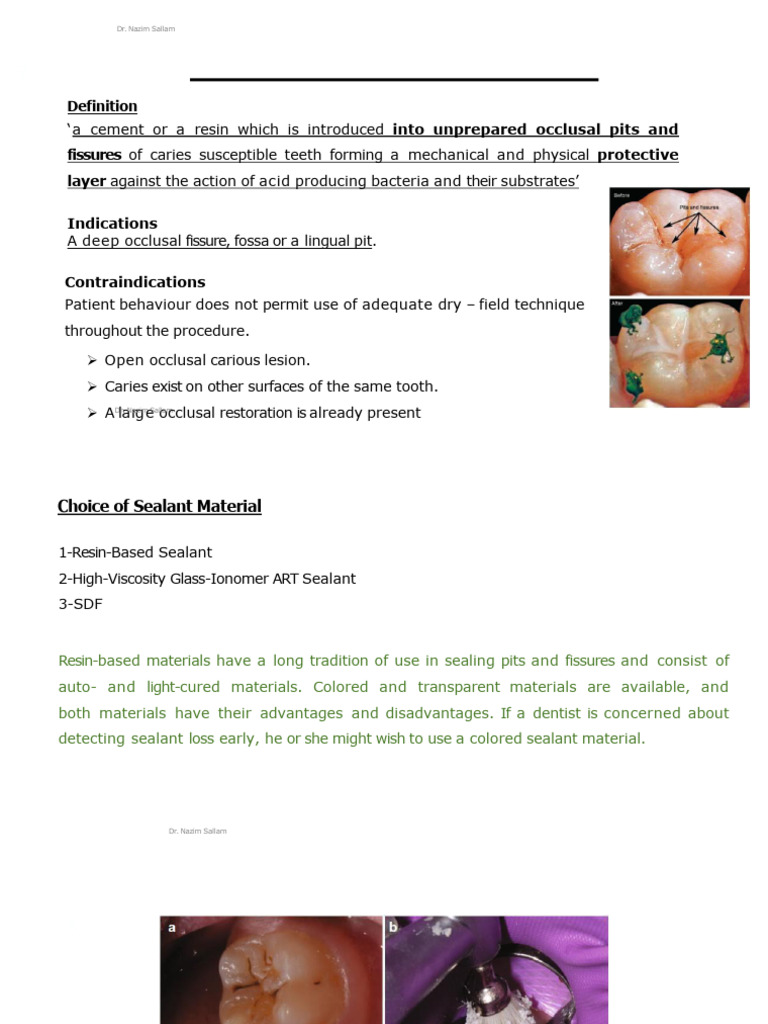 pit and fissure | PDF | Dentistry Branches | Dentistry