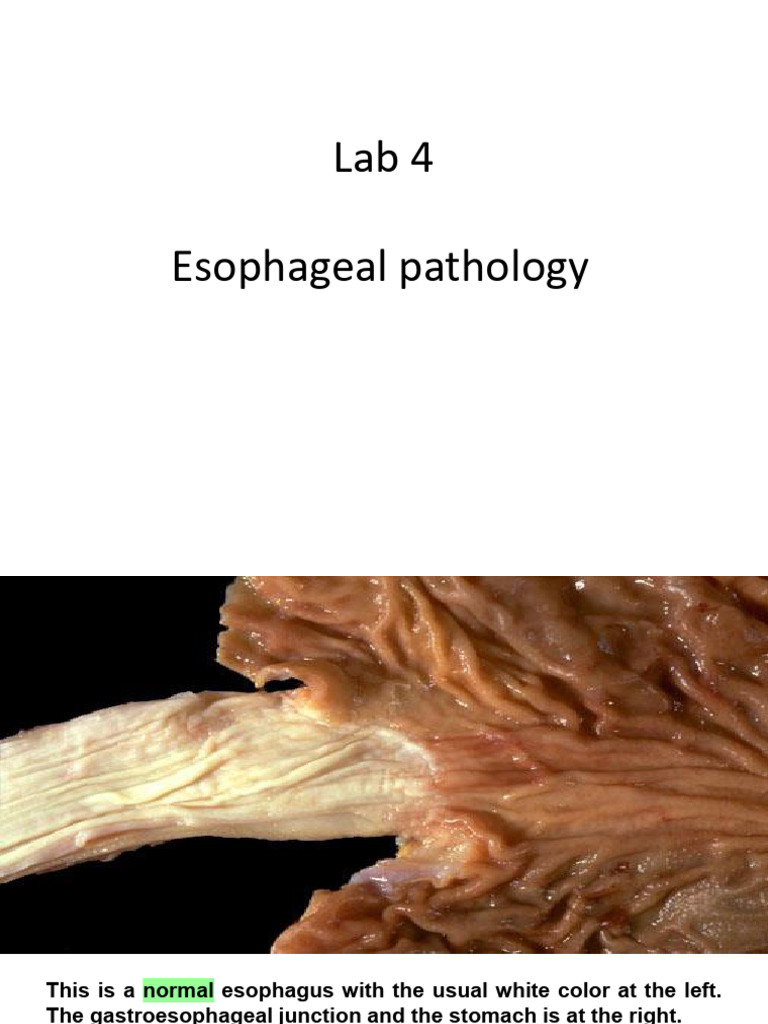Esophageal Pathology Lab | PDF | Esophagus | Adenocarcinoma