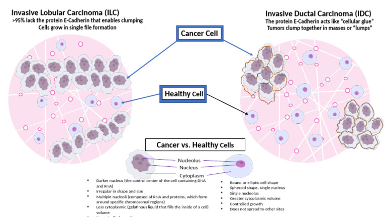 ILC vs. IDC Comparison Graphic For Maggie | PDF